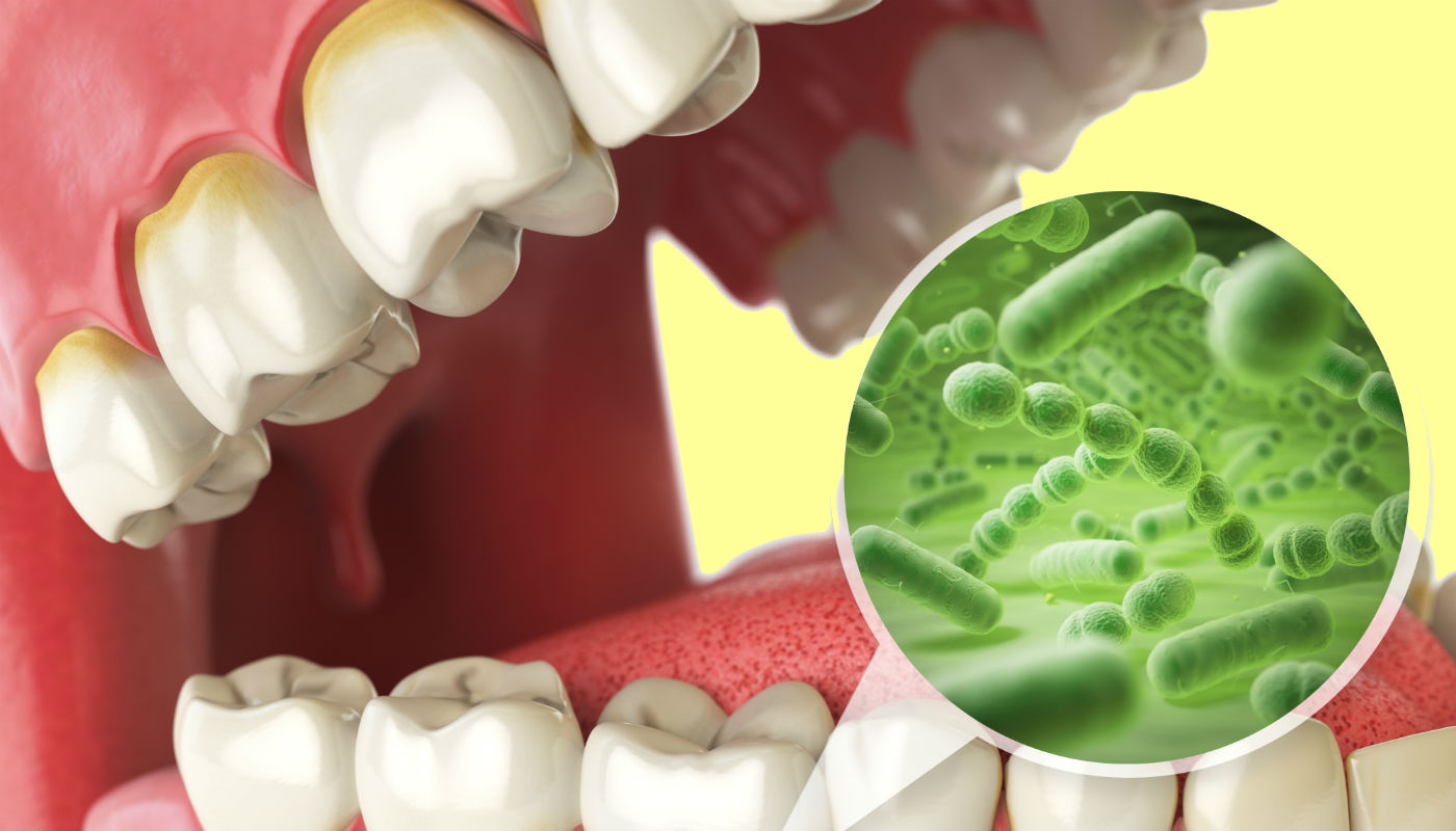 O mau hálito e suas doenças bucais e sistêmicas – Polimplant